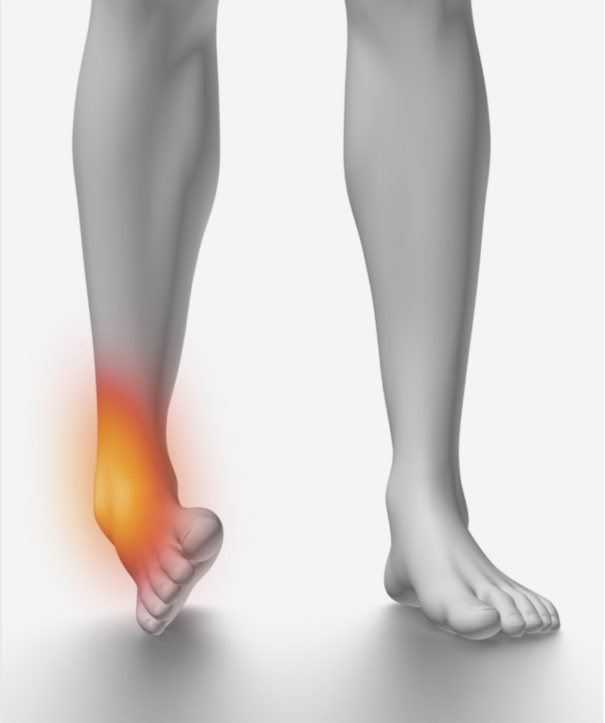 Ankle Sprain vs. Ankle Fracture | Advanced Ortho and Spine