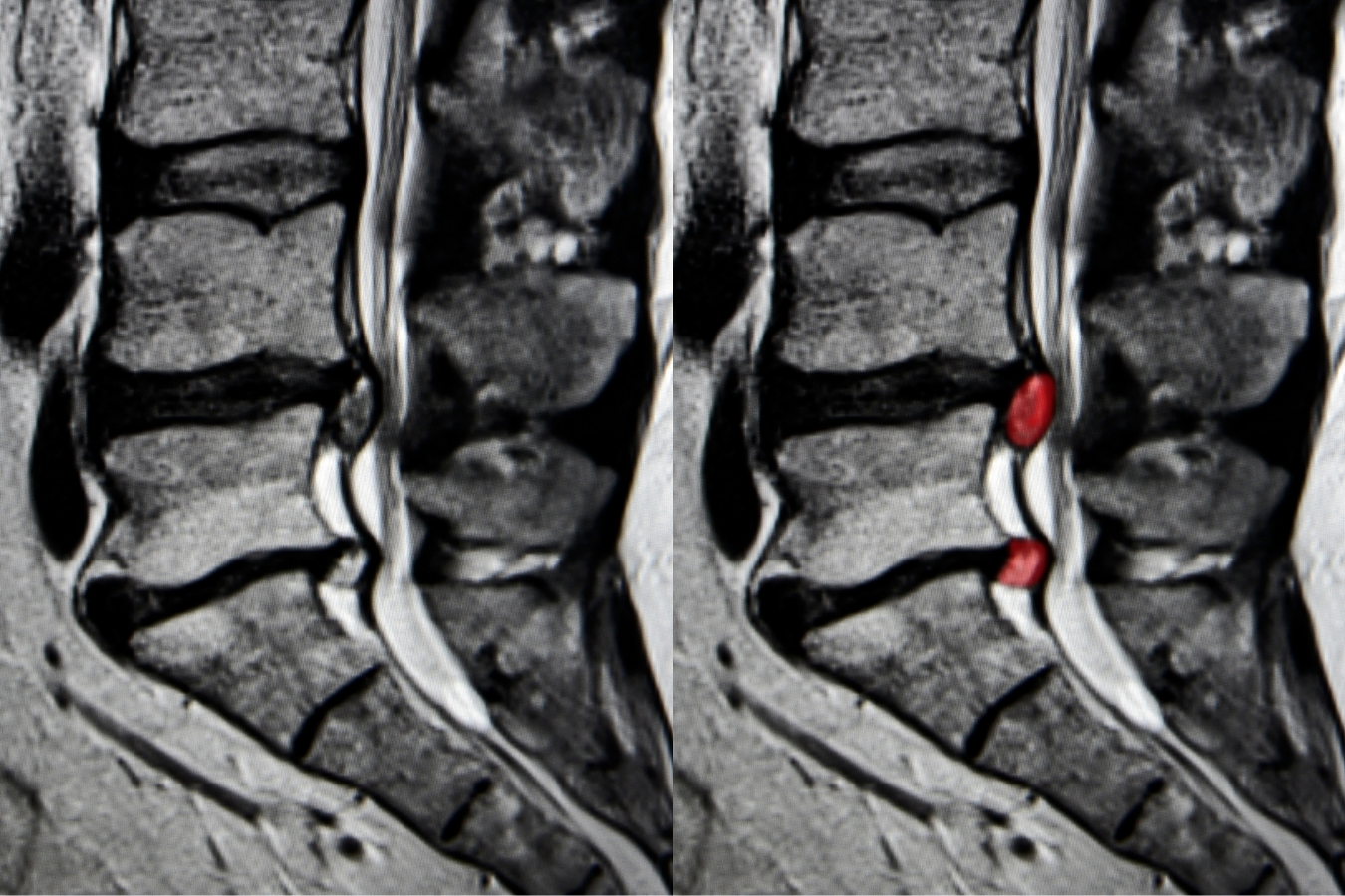 All About Sciatica From a Herniated Disc | Advanced Ortho and Spine