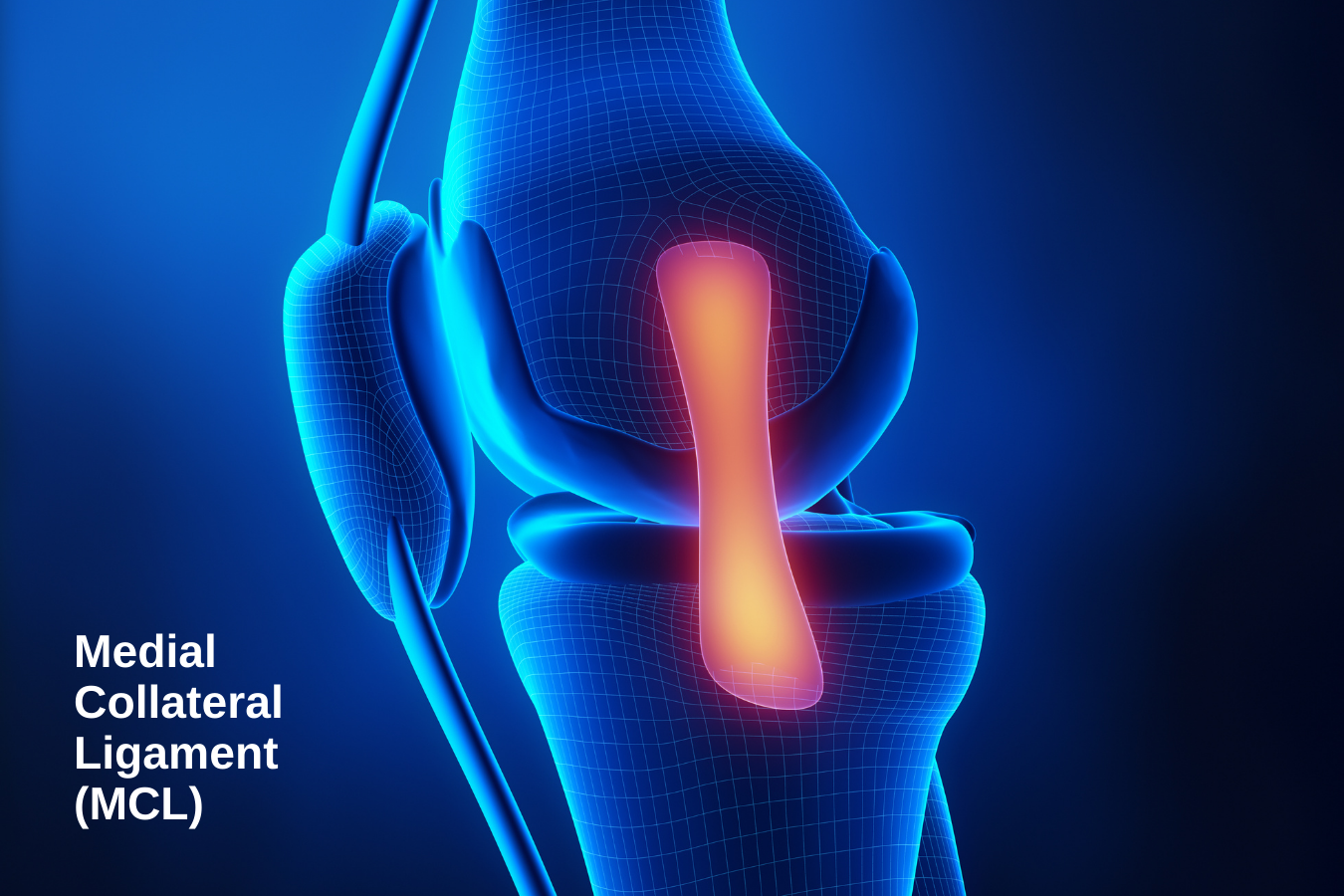 The Difference Between an ACL & MCL Tear | Advanced Ortho and Spine