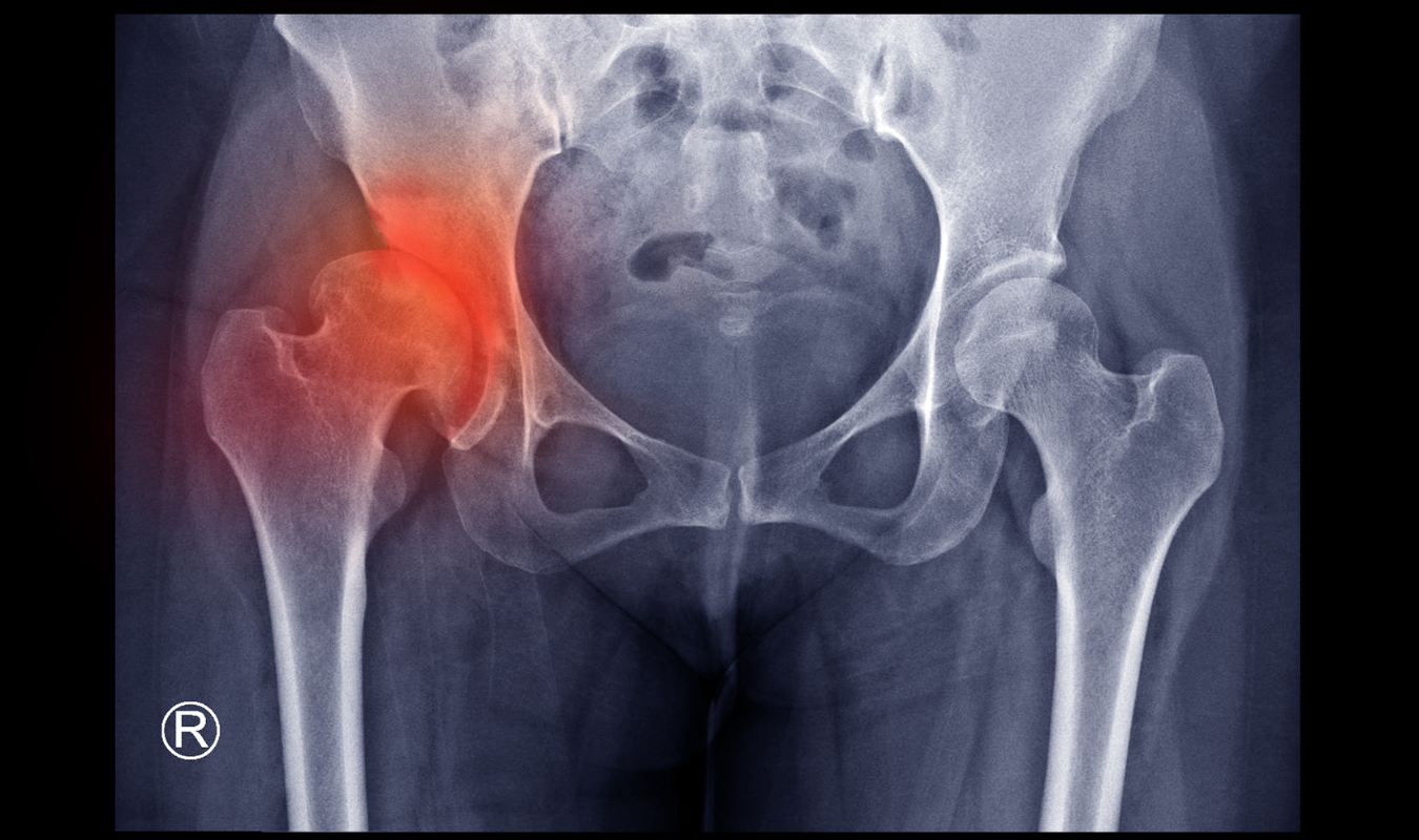 All About Hip Dysplasia | Advanced Ortho and Spine