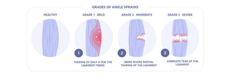 Ankle Sprains: Different Types & Grades