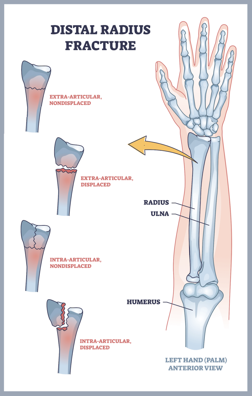 Wrist Sprain vs. Wrist Fracture | Advanced Ortho and Spine