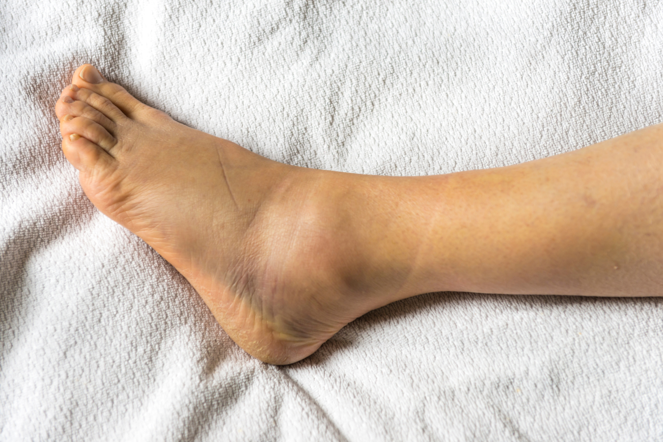 Sprained Ankle vs. Rolled Ankle | Advanced Ortho and Spine