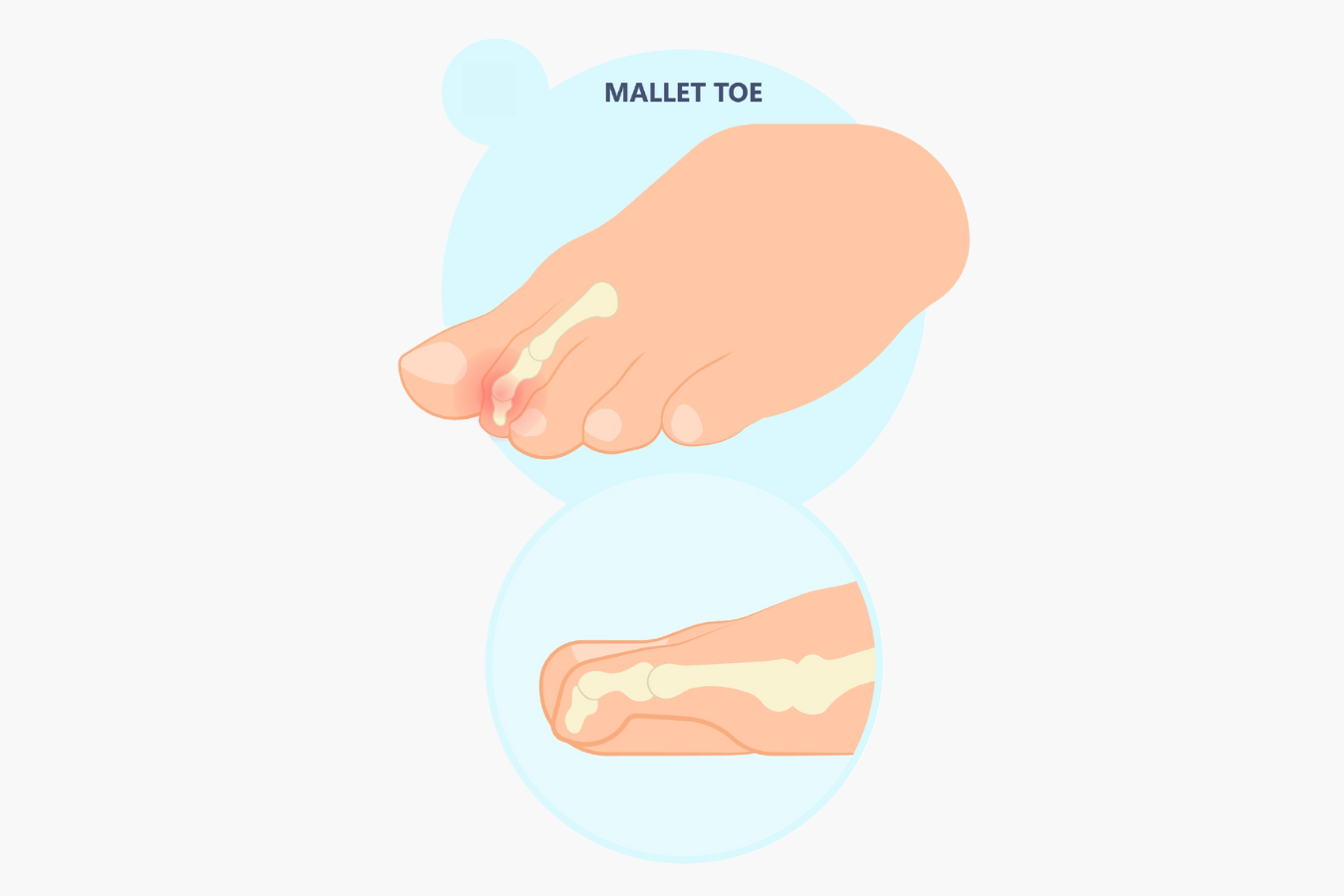 Hammertoe & Mallet Toe: A Comprehensive Guide | AOS