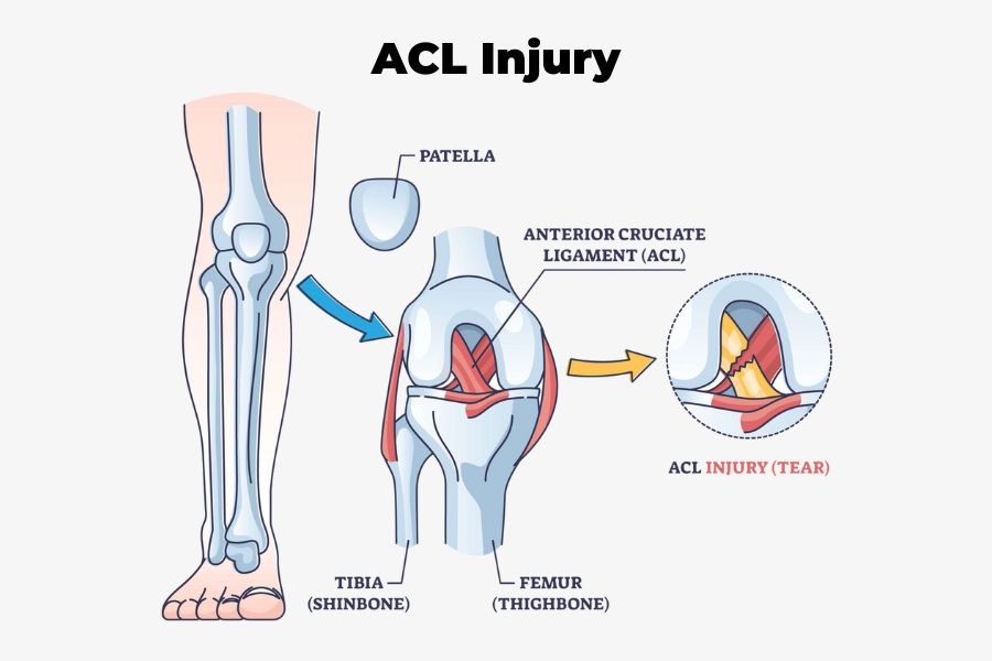 ACL Injuries: An Overview | Advanced Ortho and Spine